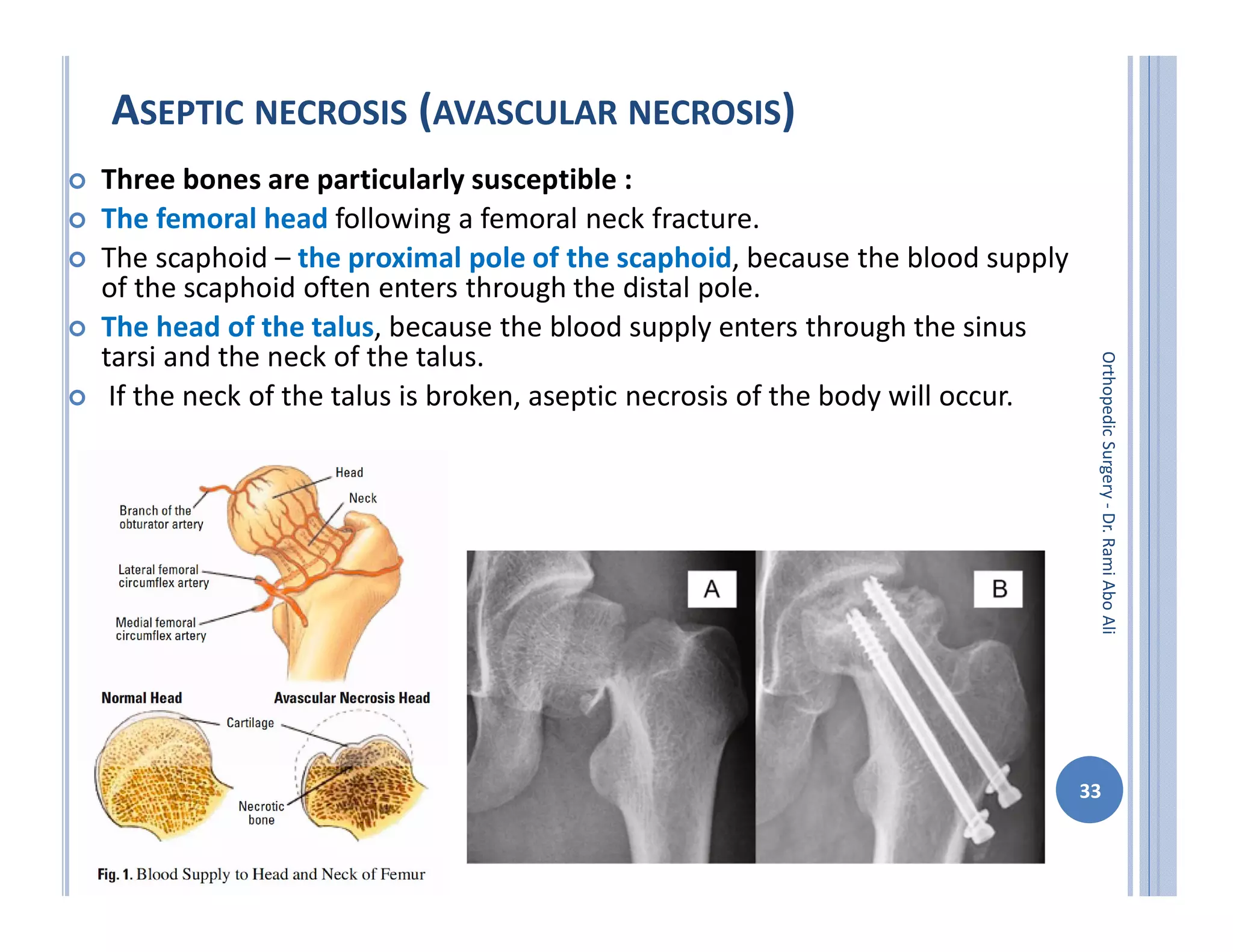 Orthopedic surgery 3rd complications of fractures | PDF