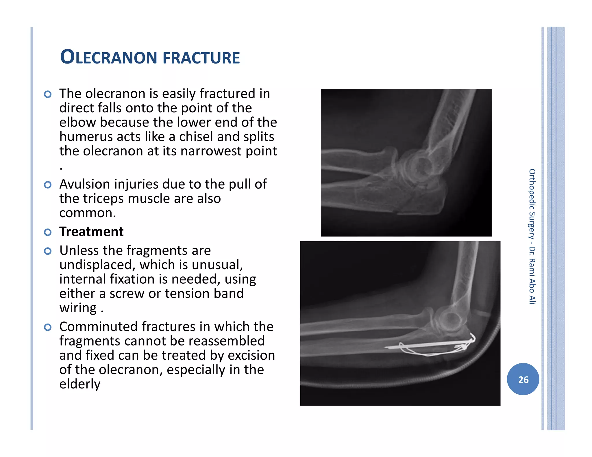 Orthopedic surgery 5th injuries to the upper limb ( 2 ) | PDF