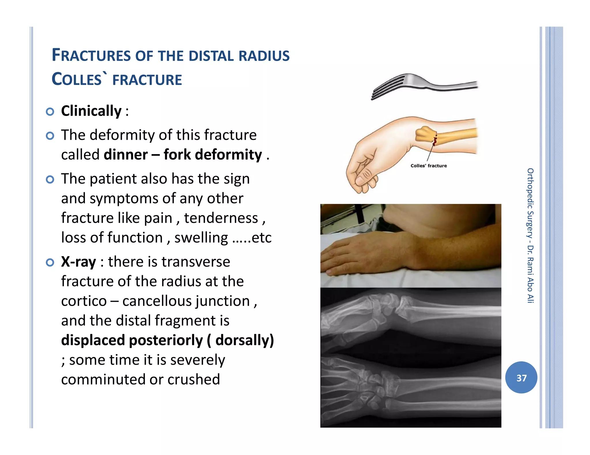 Orthopedic surgery 5th injuries to the upper limb ( 2 ) | PDF