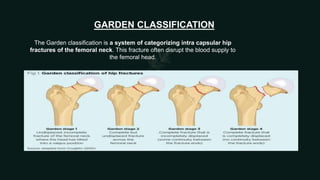 fracture of neck of femur | PPTX