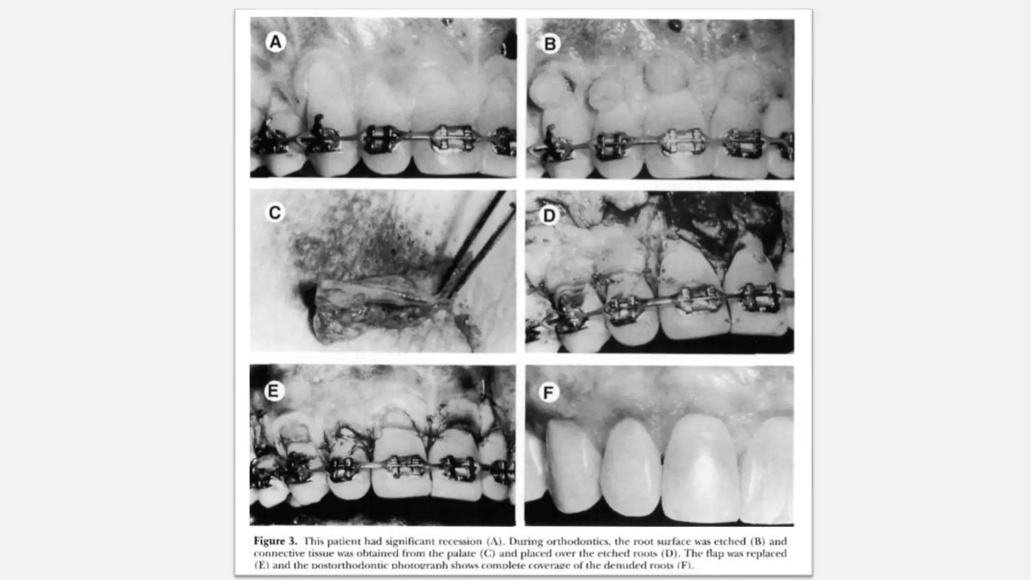 Managing treatment for the orthodontic patient with periodontal ...
