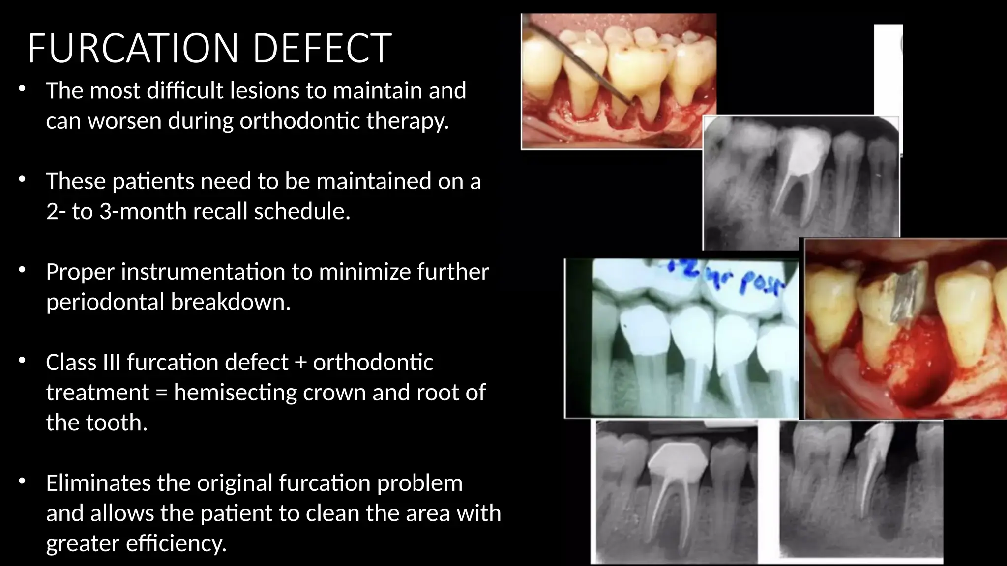 Adjuvant role of orthodontics in periodo | PPTX