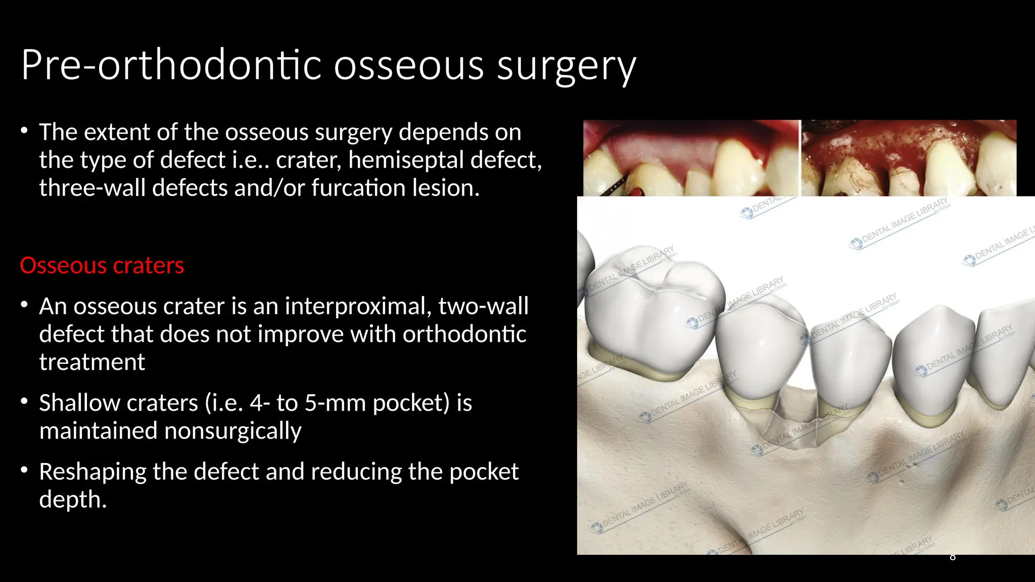 Adjuvant role of orthodontics in periodo | PPTX