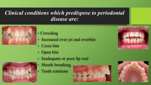 ORTHODONTICS PERIODONTICS RELATIONSHIP.pptx | Dental Health | Diseases and Conditions