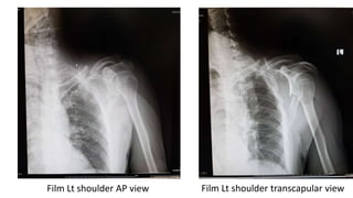 Floating shoulder | PPTX