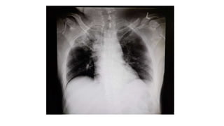 Floating shoulder | PPTX
