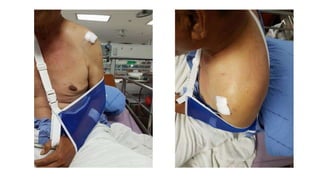 Floating shoulder | PPTX