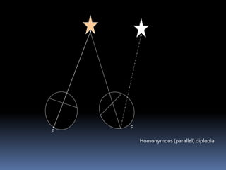 Orthoptic approach to dipolopia | PPT