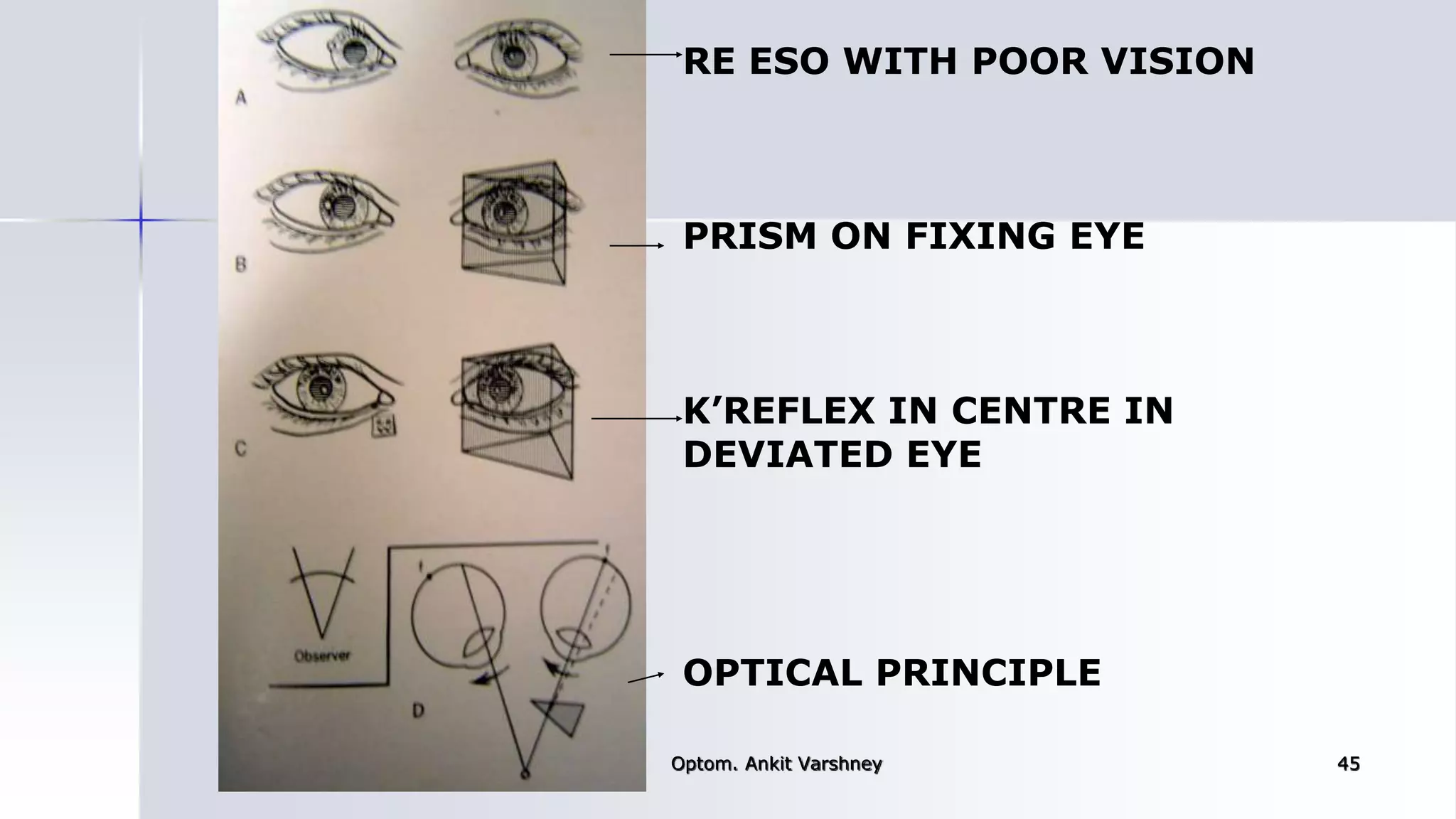 Orthoptics by ankit varshney | PPT