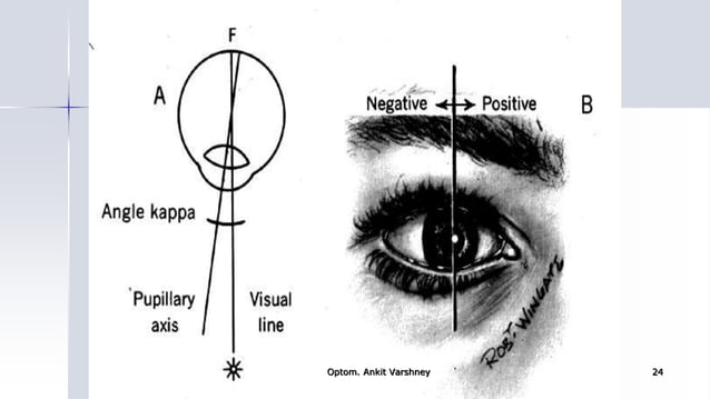 Orthoptics by ankit varshney | PPT | Eye and Vision Conditions ...