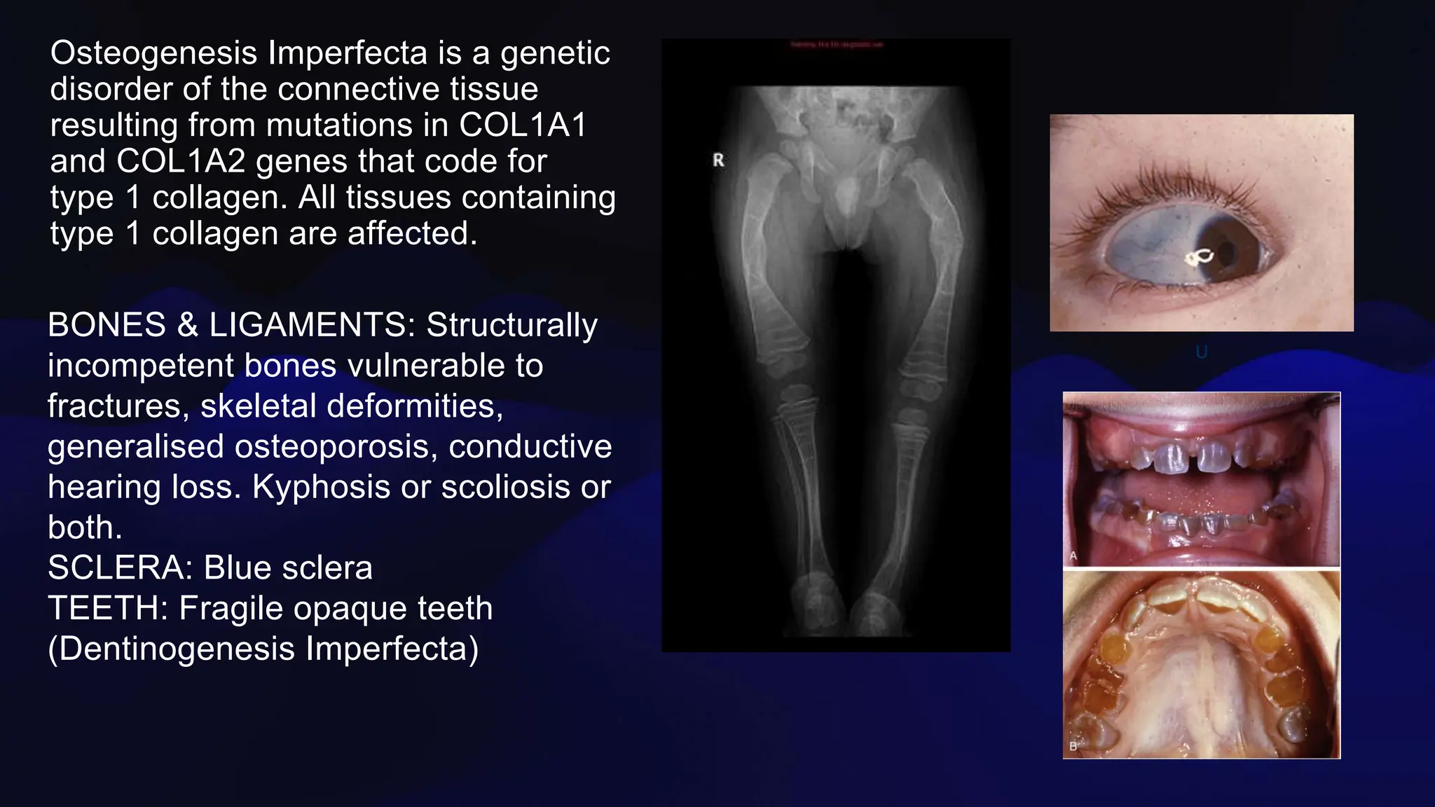Osteogenesis Imperfecta Etiology Clinical features Classification ...