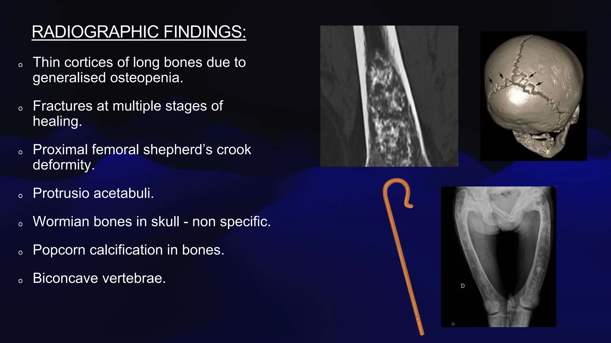 Osteogenesis Imperfecta Etiology Clinical features Classification ...