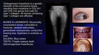 Osteogenesis Imperfecta Etiology Clinical features Classification ...