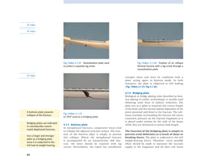 Screws and plates used in orthopaedic trauma fixation | PDF