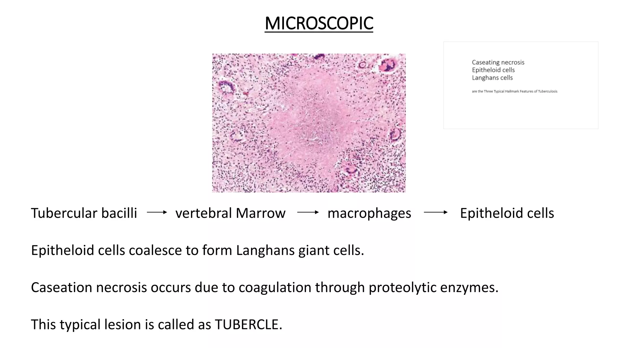 Skeletal Tuberculosis Orthopaedics Seminar | PPTX