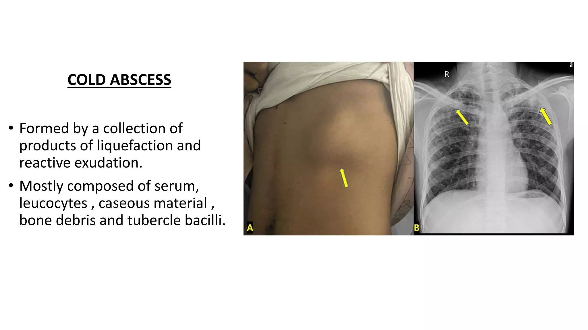 Skeletal Tuberculosis Orthopaedics Seminar | PPTX