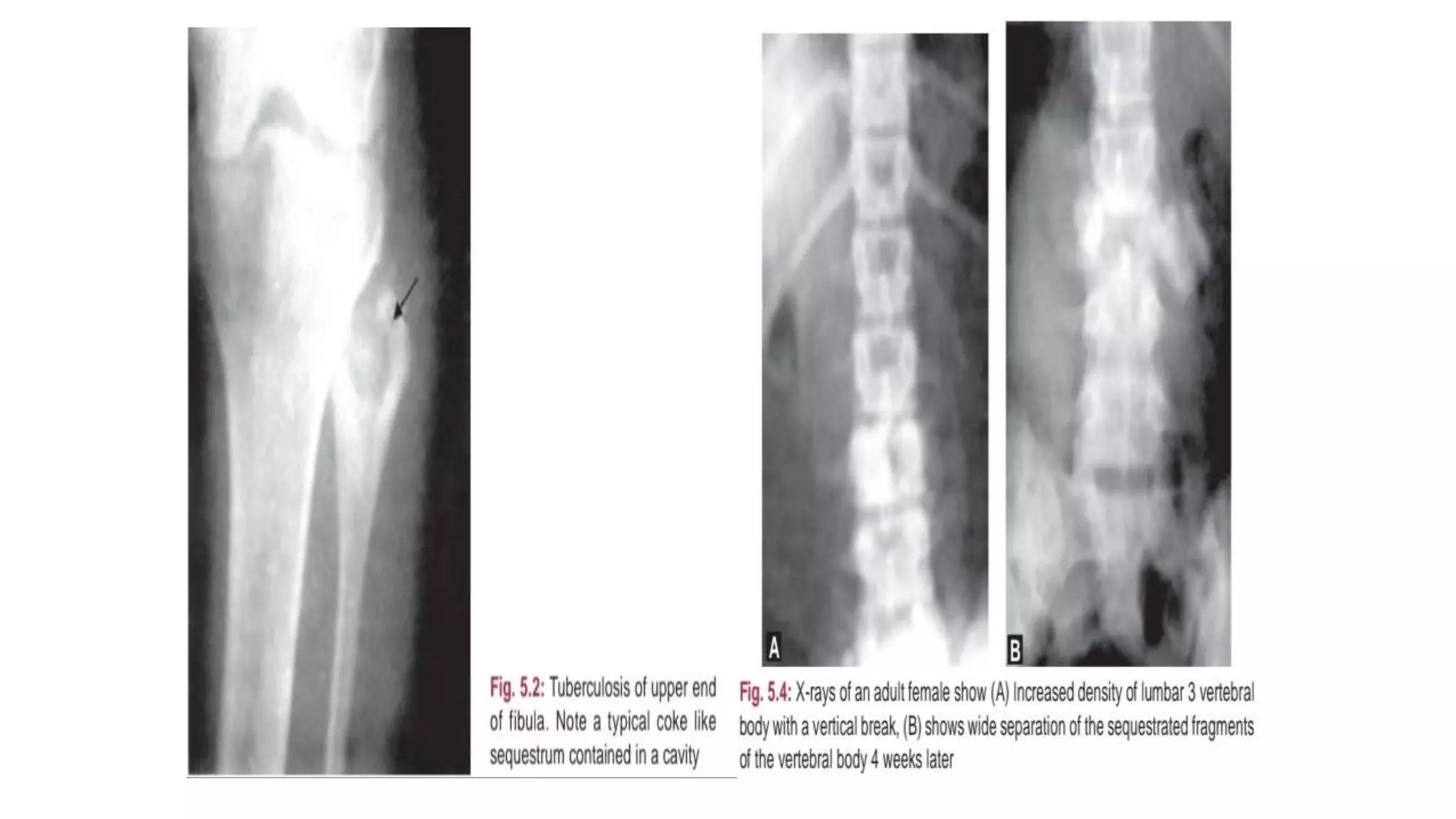 Skeletal Tuberculosis Orthopaedics Seminar | PPTX