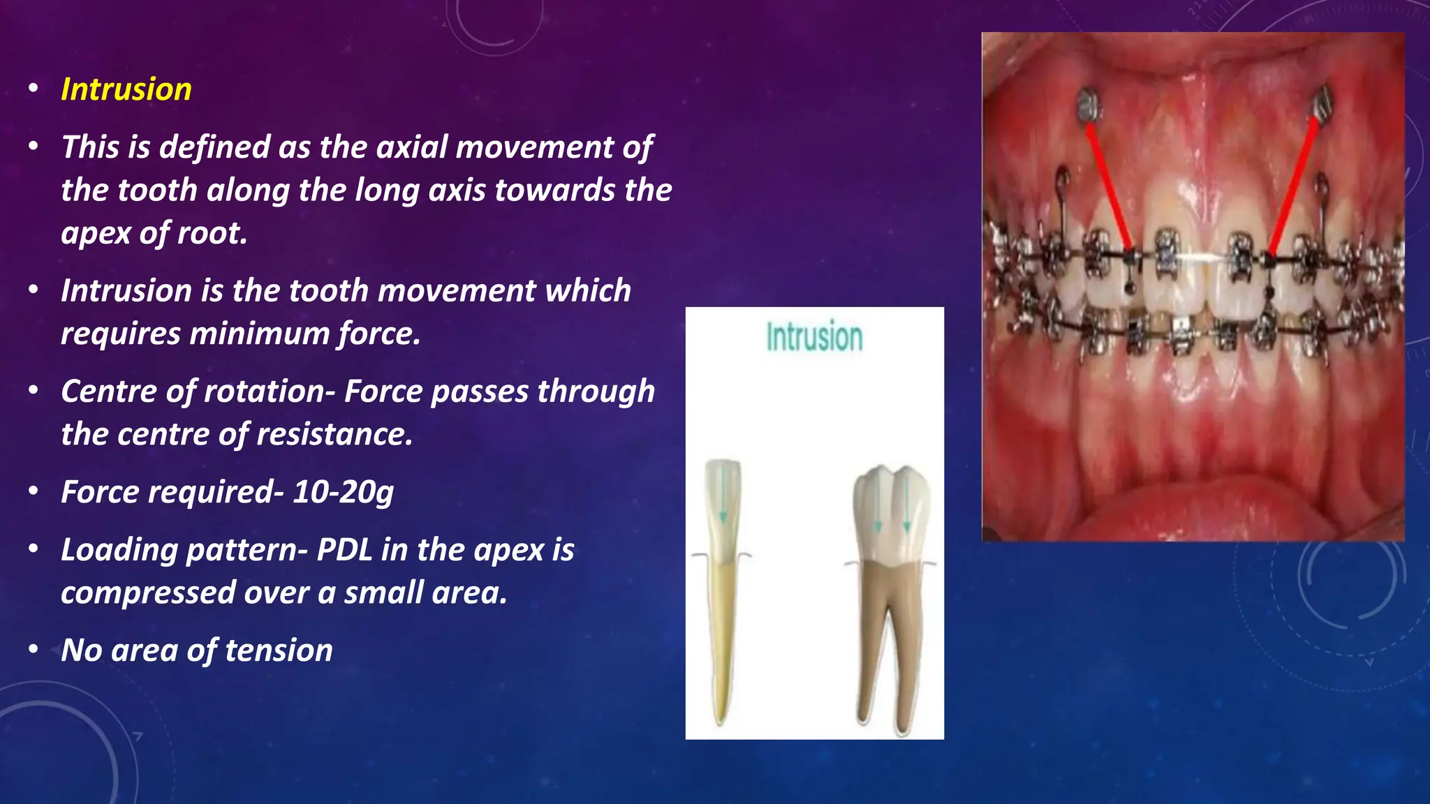 ortho seminar biomechanics of tooth movement | PPTX