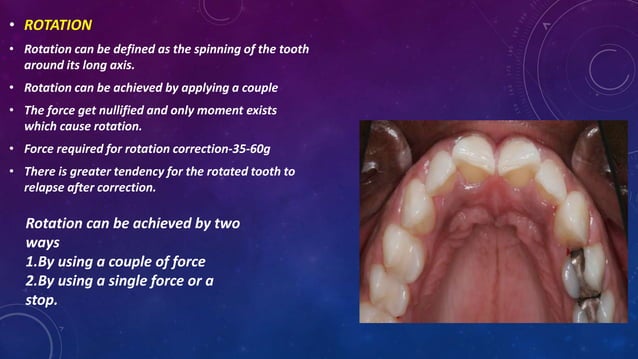 ortho seminar biomechanics of tooth movement | PPTX | Dental Health ...