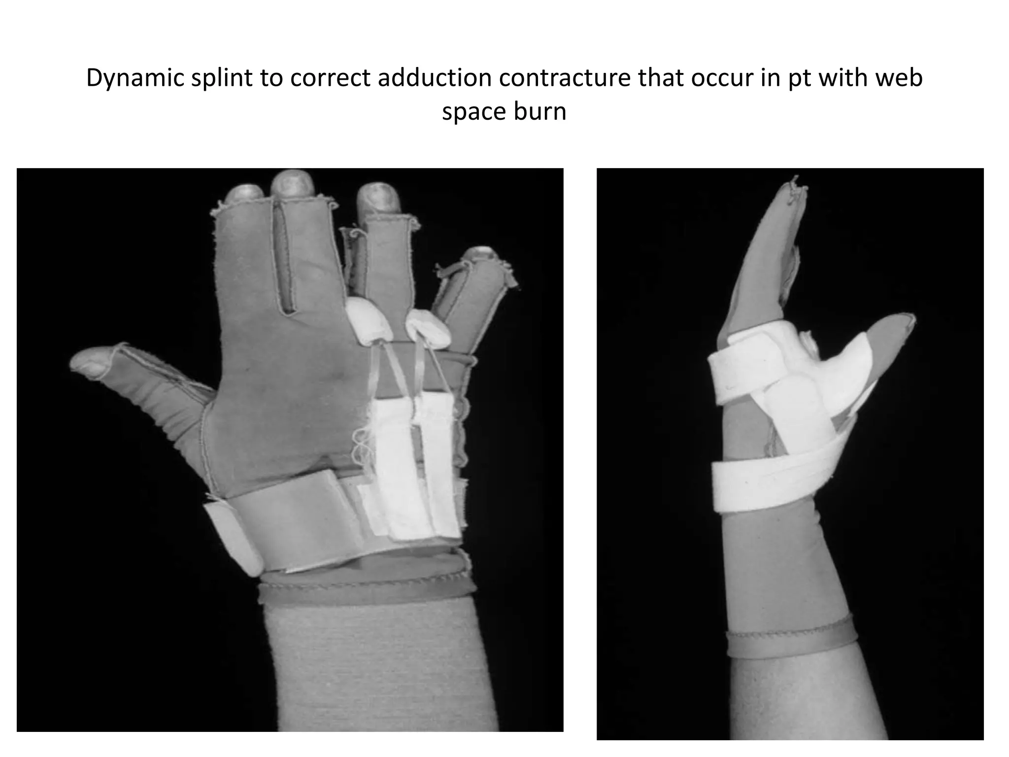 Orthoses for burns management | PPTX