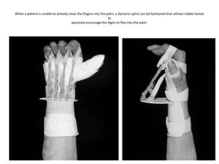 Orthoses for burns management | PPTX