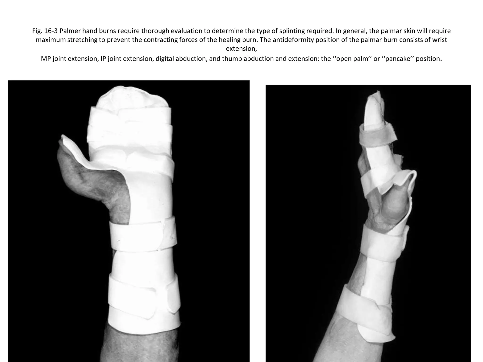 Orthoses for burns management | PPT