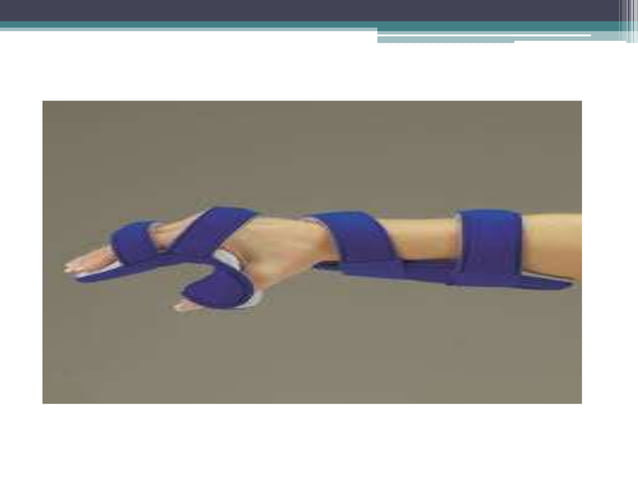 Orthosis of hand ppt | PPTX