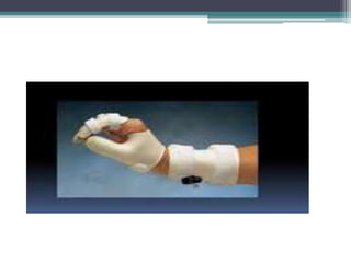 Orthosis of hand ppt | PPTX