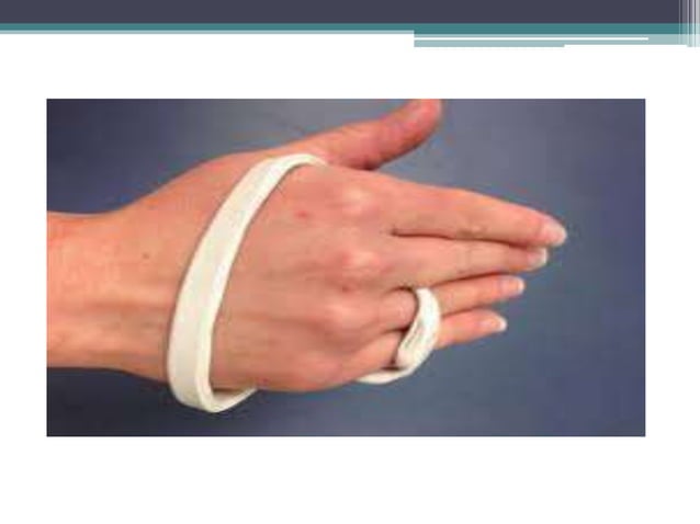Orthosis of hand ppt | PPTX