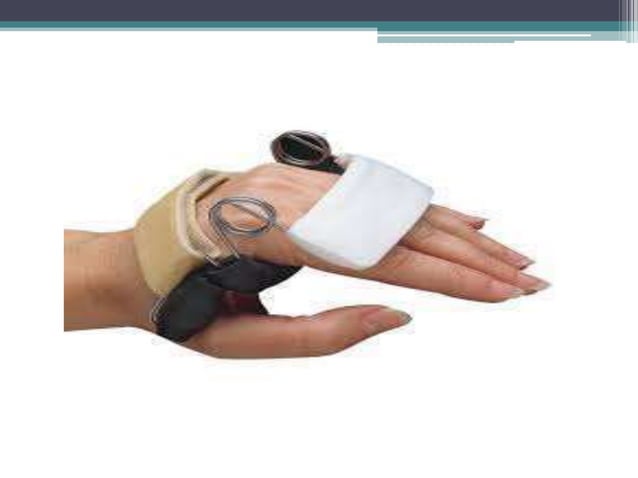 Orthosis of hand ppt | PPTX