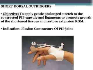 Orthosis of hand ppt | PPTX