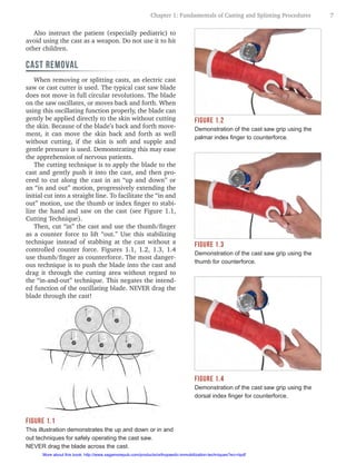 Ortho spinting casting | PDF