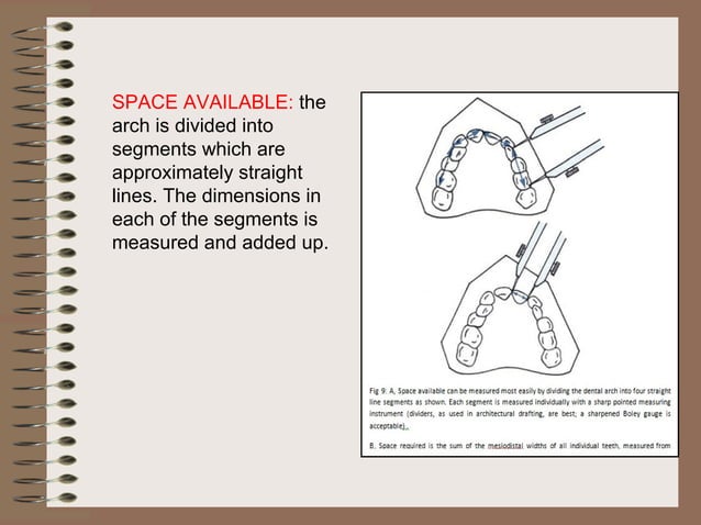 Ortho Study Model Analysis Ppt