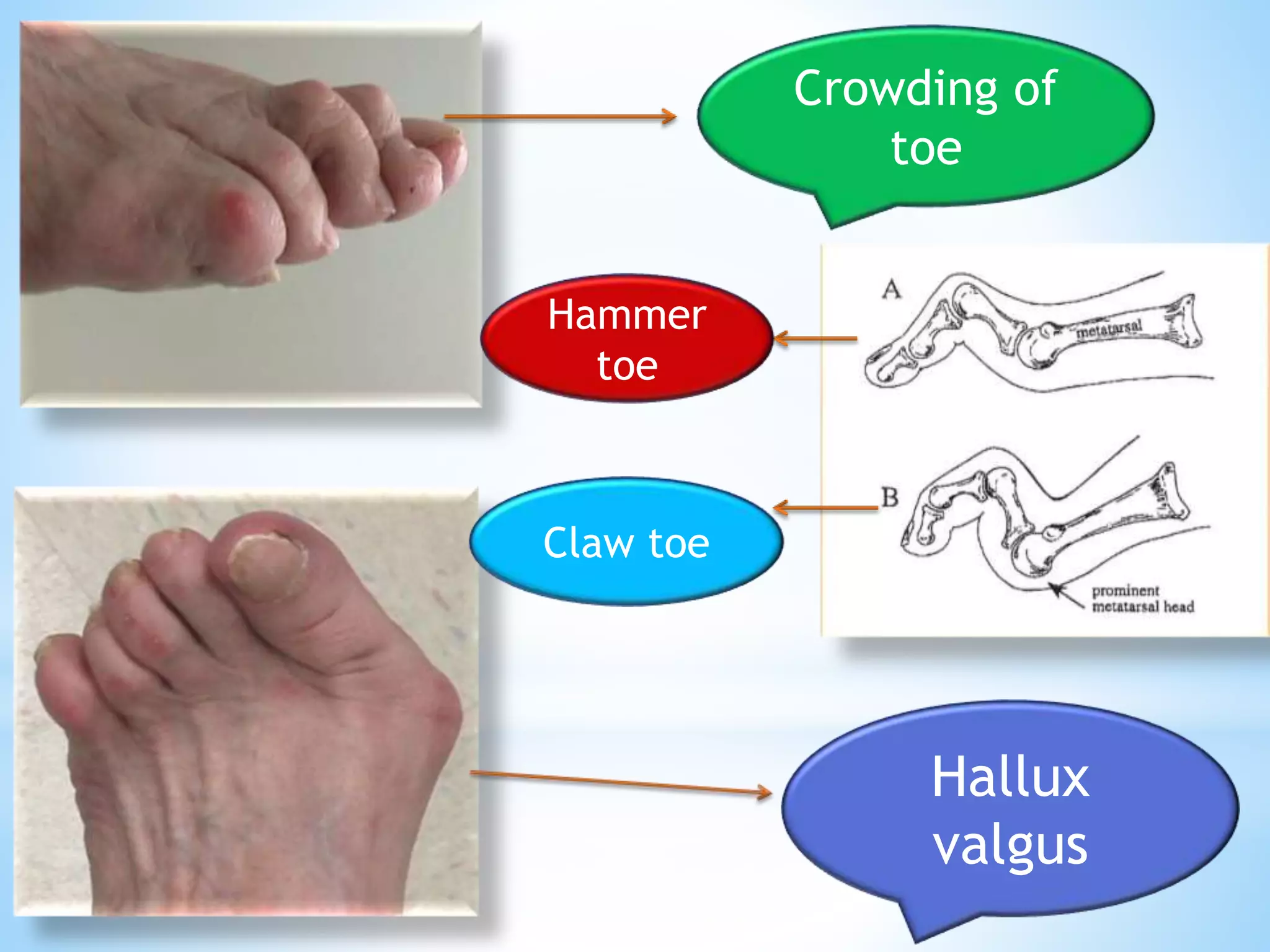 Orthotic management of diabetes mellitus foot | PPTX