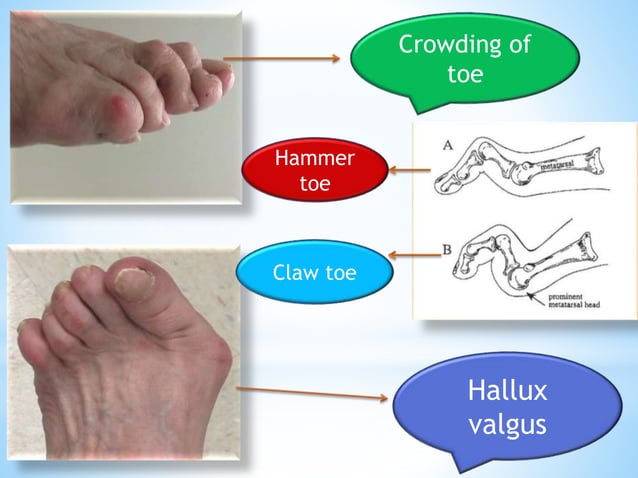 Orthotic management of diabetes mellitus foot | PPTX