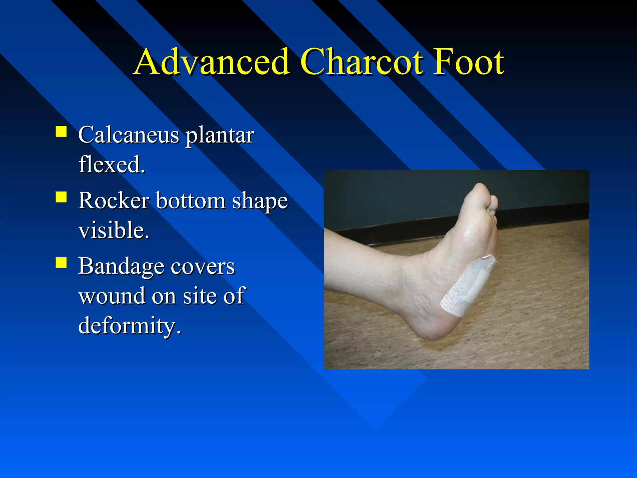 Orthotic Management of Charcot Foot | PPT