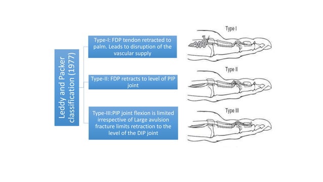Orthotic management of Elbow joint, Wrist Joint.pptx