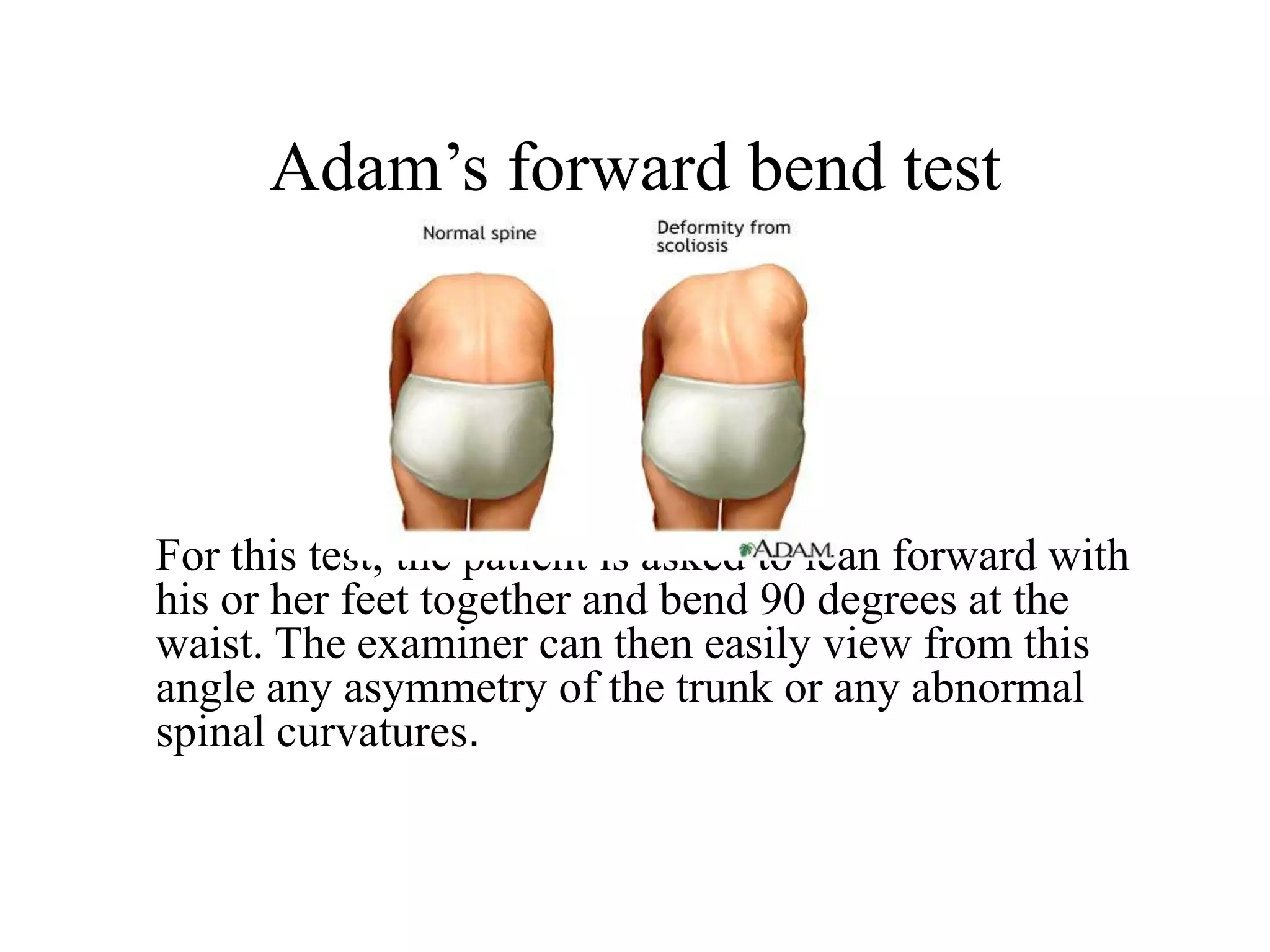 Orthotic management of scoliosis | PPTX