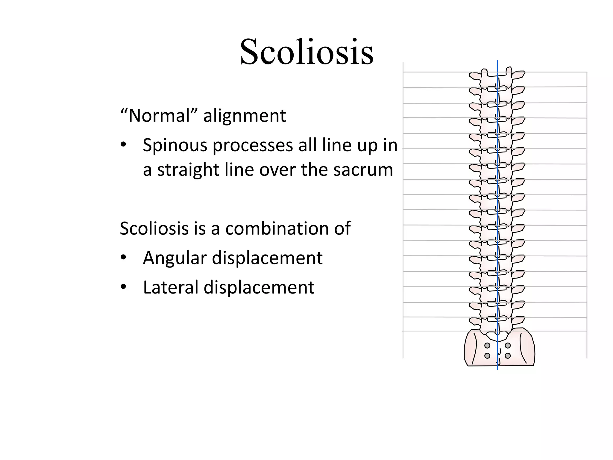 Orthotic management of scoliosis | PPTX