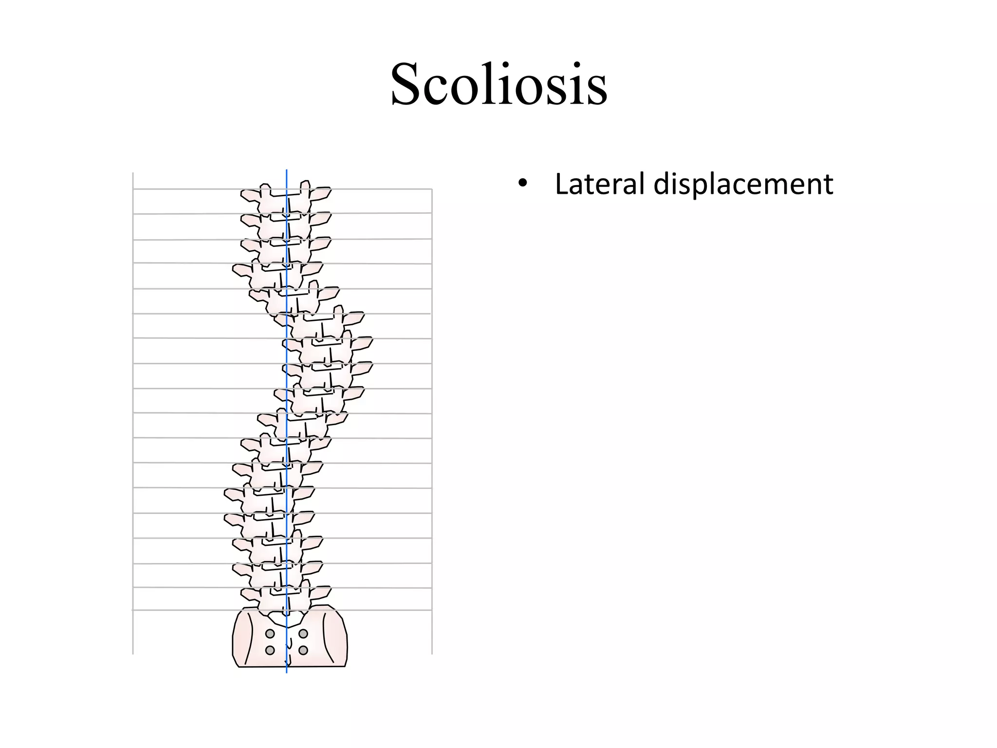 Orthotic management of scoliosis | PPTX