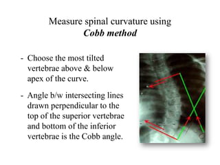 Orthotic management of scoliosis | PPTX