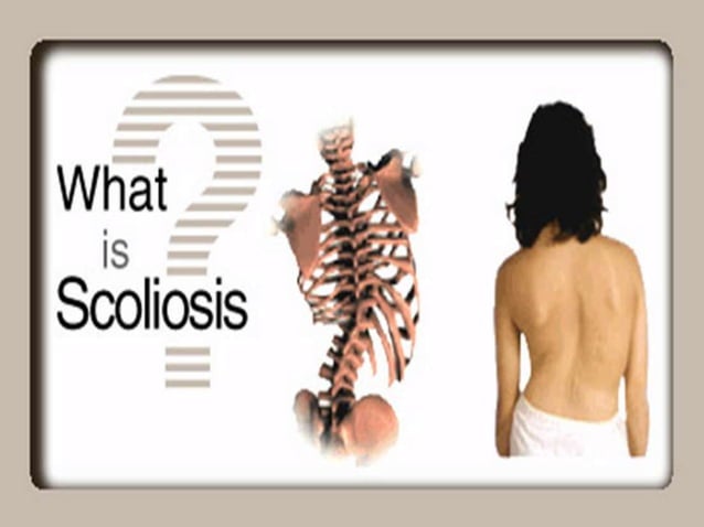 Orthotic management of scoliosis | PPTX | Physical Therapy | Wellness