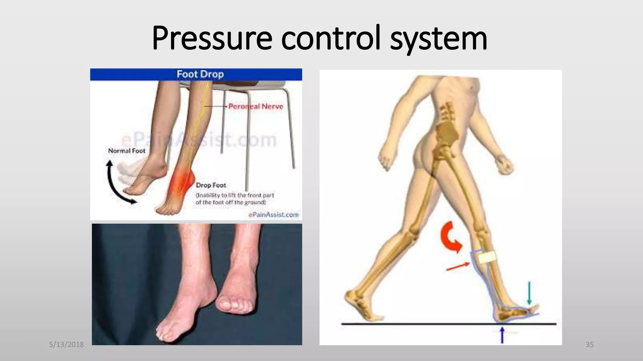 Orthotic treatment for cp patients (ridoy) | PPTX