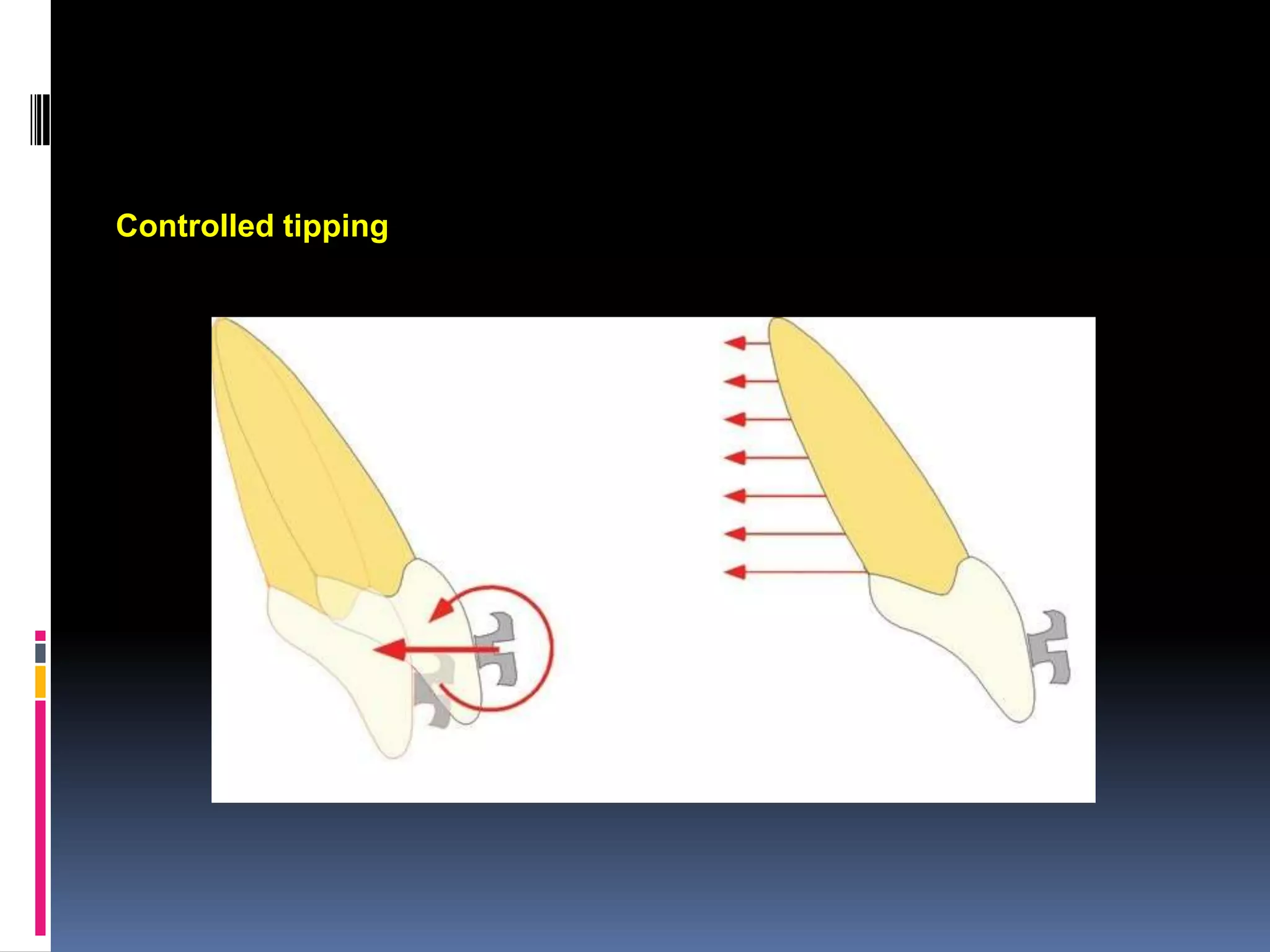 Orthodontic tooth movement ppt. | PPTX