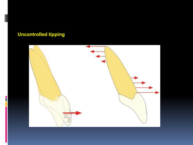 Orthodontic tooth movement ppt. | PPTX | Dental Health | Diseases and ...