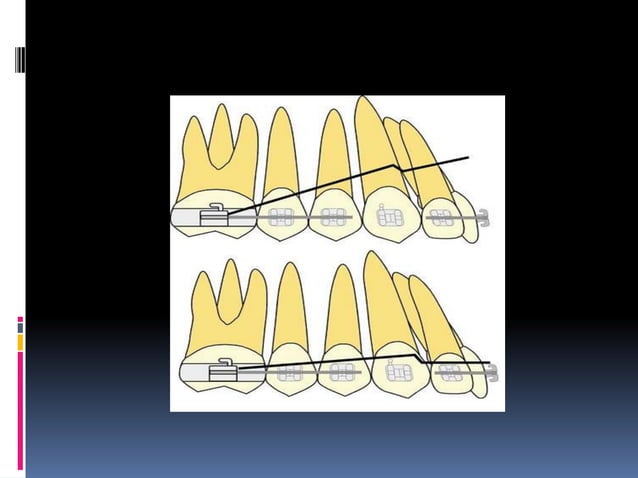 Orthodontic tooth movement ppt. | PPTX | Dental Health | Diseases and ...