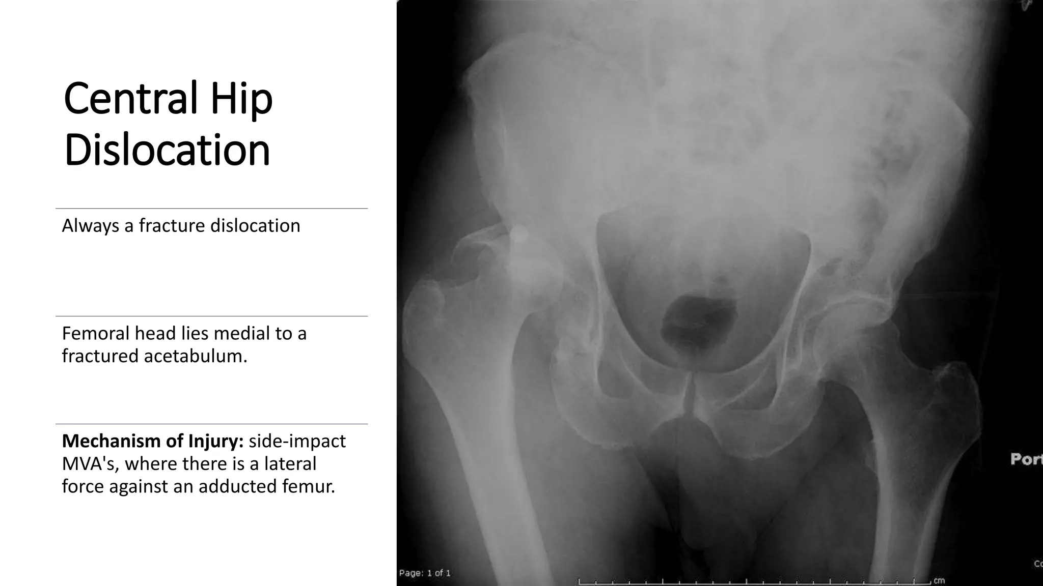 Hip Dislocations: Ortho topic presentation 2018 | PPT