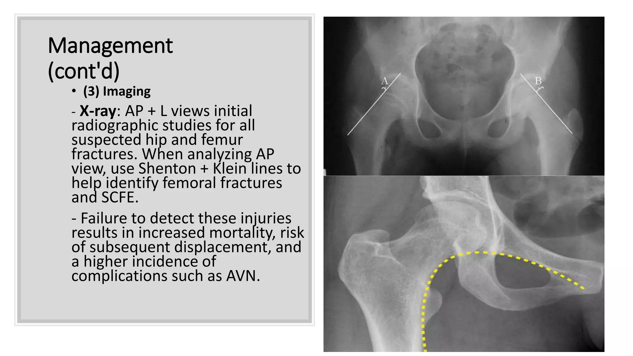 Hip Dislocations: Ortho topic presentation 2018 | PPTX