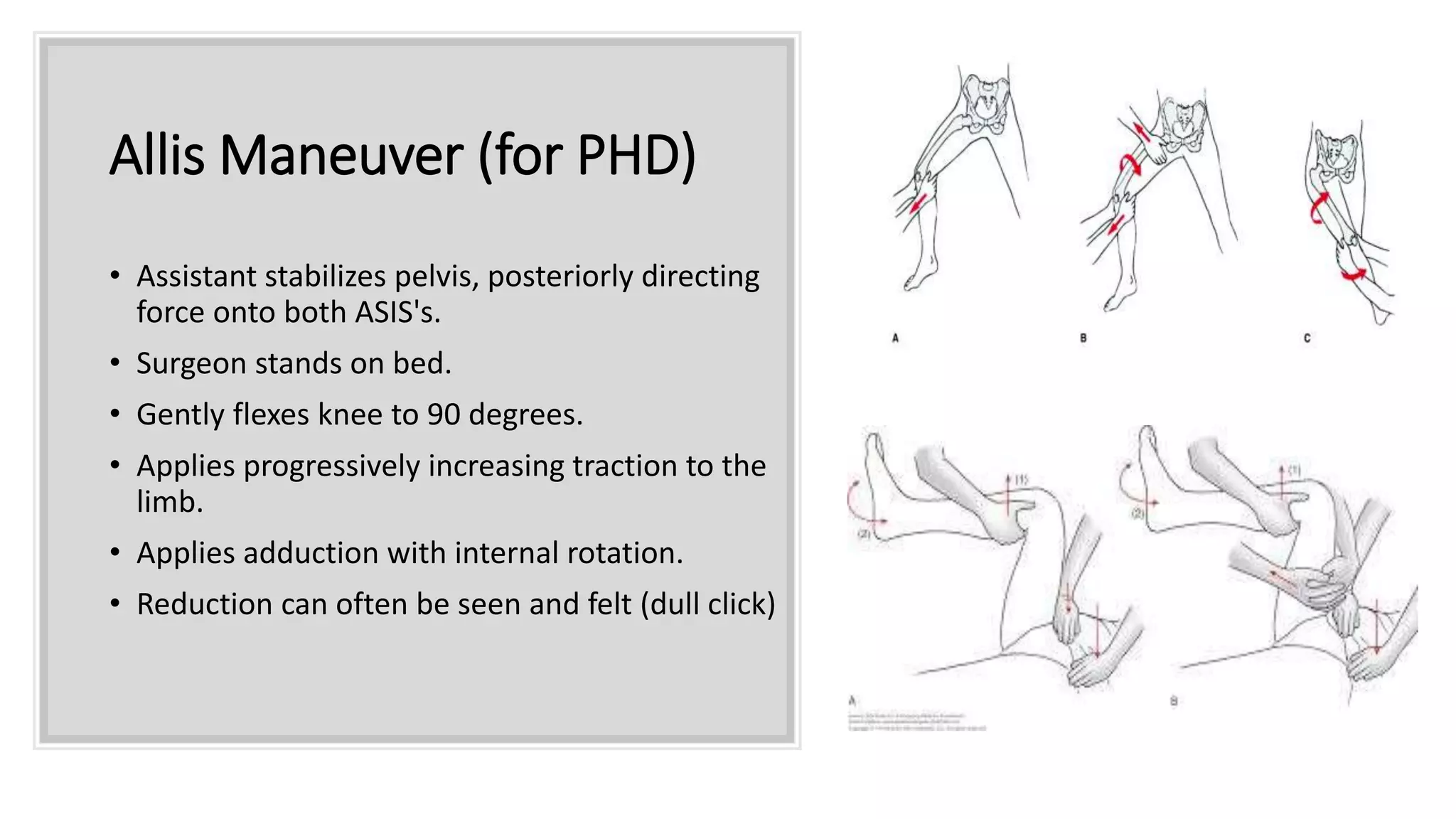 Hip Dislocations: Ortho topic presentation 2018 | PPTX