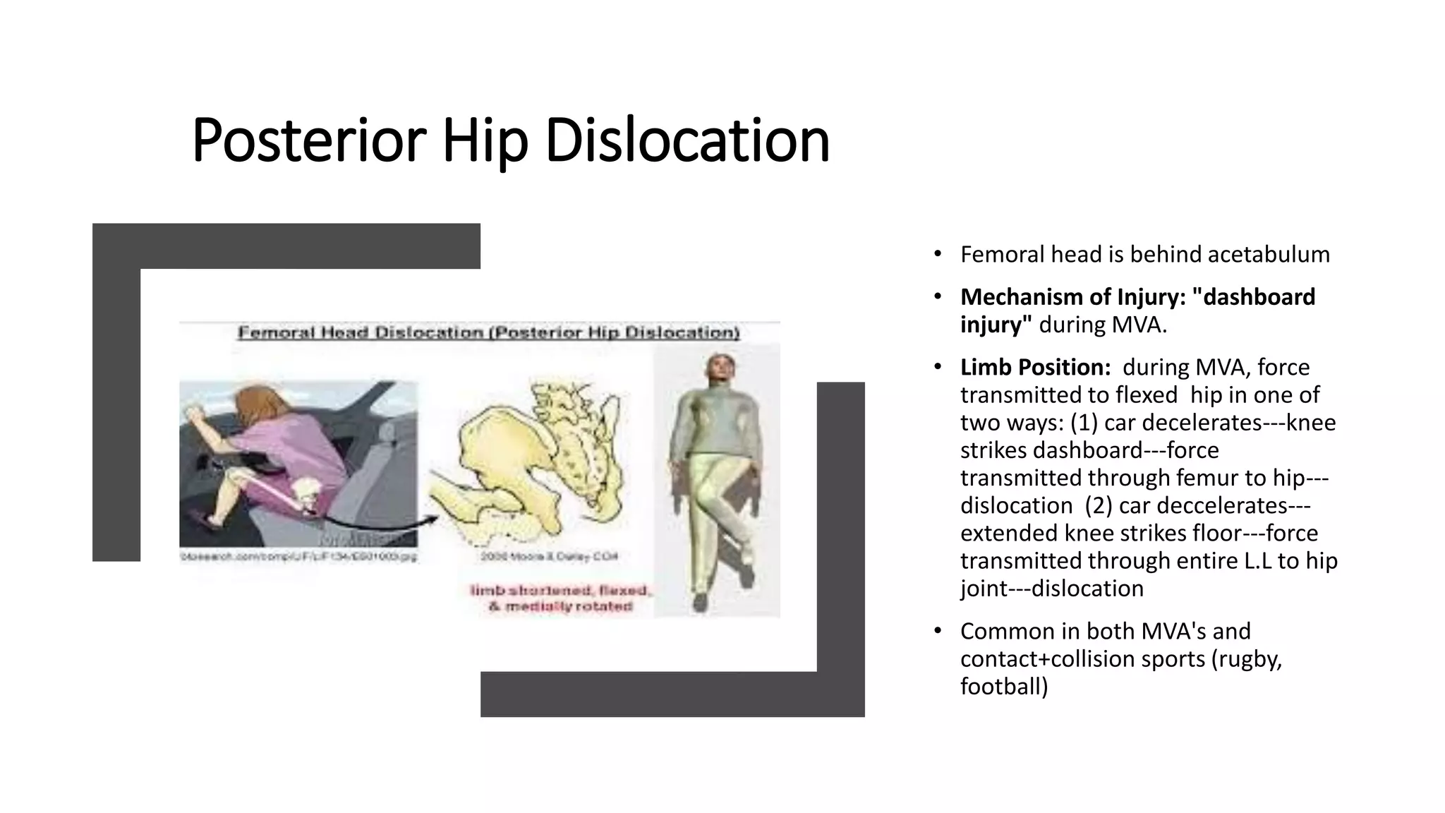 Hip Dislocations: Ortho topic presentation 2018 | PPTX